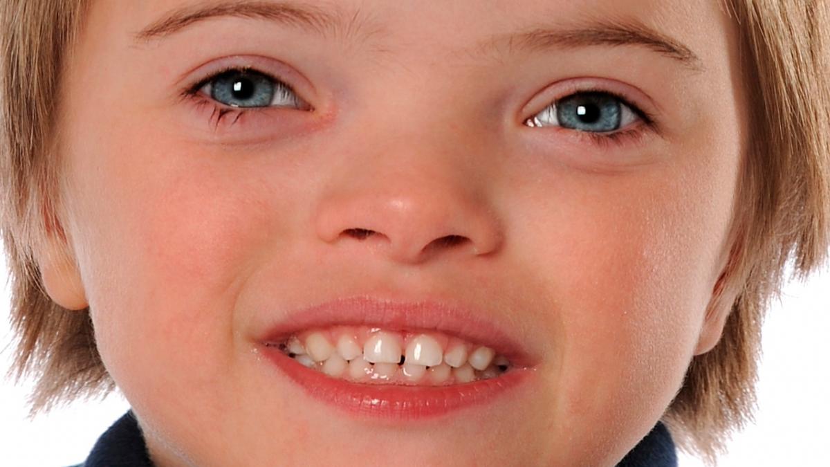 Sindrome De Noonan Adultos